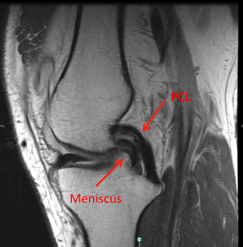 Double PCL Sign | Bucket Handle Tear of Meniscus | How to Read an MRI of the Knee - Robert ...