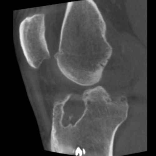 ACL Reconstruction | Anterior Cruciate Ligament Surgery | Knee ...