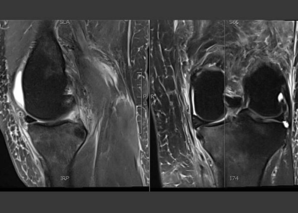 Medial Meniscus Tear | Knee Specialist | Minnesota