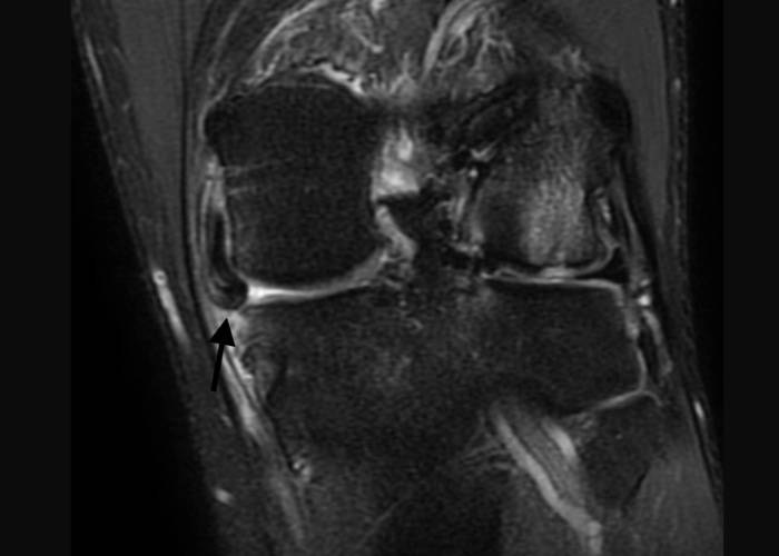 Posterior Horn Medial Meniscus Tear | Knee Specialist | Minnesota