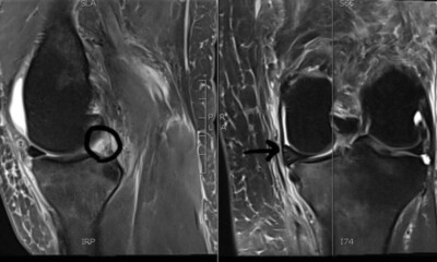 Meniscal Root Tears | Knee Specialist | Minnesota