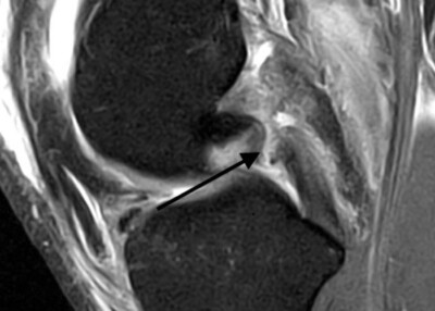 PCL Reconstruction | Posterior Cruciate Ligament Surgery | Minnesota