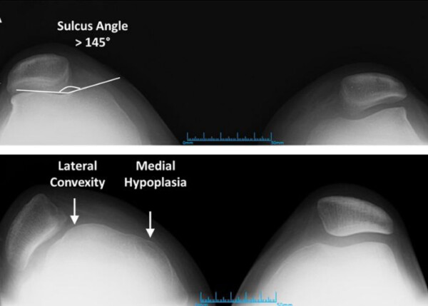 Trochleoplasty | Knee Surgeon | Minnesota