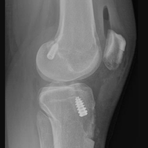 ACL Reconstruction | Anterior Cruciate Ligament Surgery | Knee ...