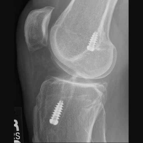 ACL Reconstruction | Anterior Cruciate Ligament Surgery | Knee ...