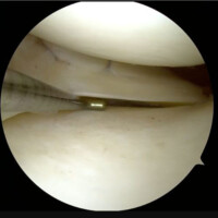 ACL Reconstruction | Anterior Cruciate Ligament Surgery | Knee ...