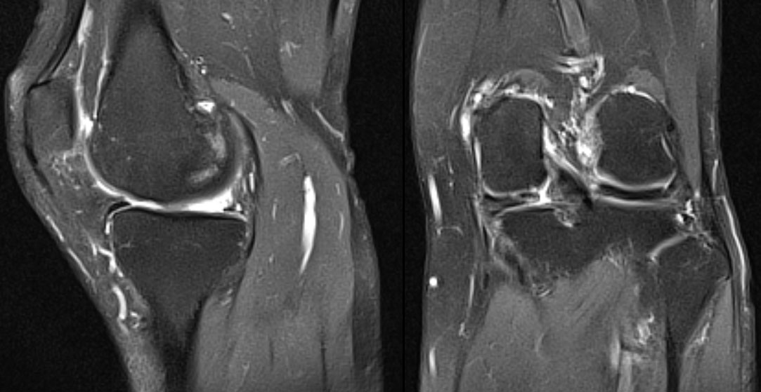 Meniscus Root Injury | MRI of the Knee - Robert LaPrade MD | Orthopedic ...