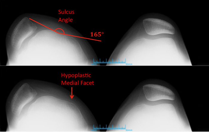 Trochlear Dysplasia | Knee Pain | Minnesota
