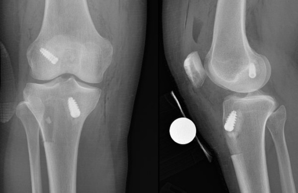 Live ACL Reconstruction Surgical Demonstration | Robert LaPrade, MD ...