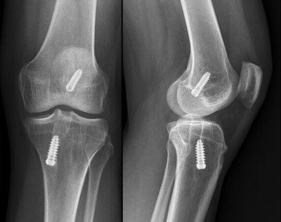 Live ACL Reconstruction Surgical Demonstration | Robert LaPrade, MD ...