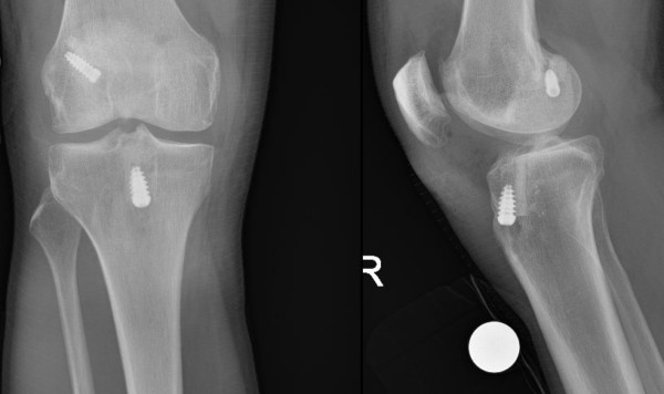 Live ACL Reconstruction Surgical Demonstration | Robert LaPrade, MD ...