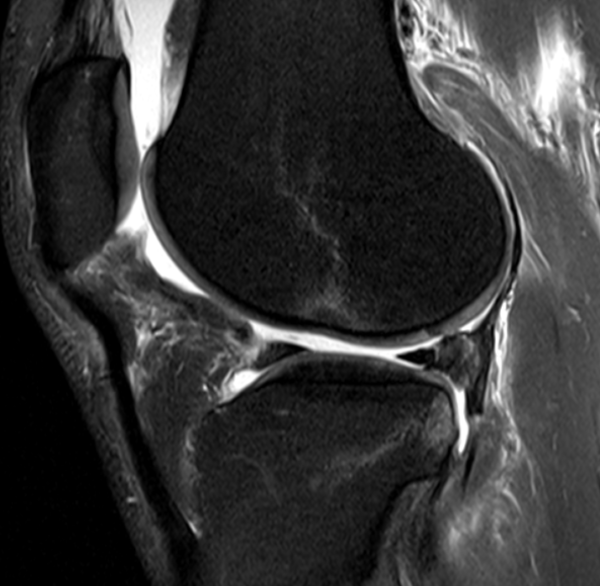 Live ACL Reconstruction Surgical Demonstration | Robert LaPrade, MD ...