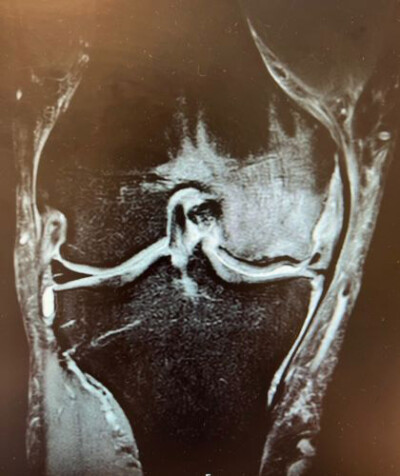 Spontaneous Osteonecrosis of the Knee | SONK | Minnesota