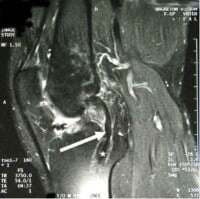 PCL Reconstruction | Posterior Cruciate Ligament Surgery | Minnesota