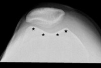 Trochlear Dysplasia | Knee Pain | Minnesota