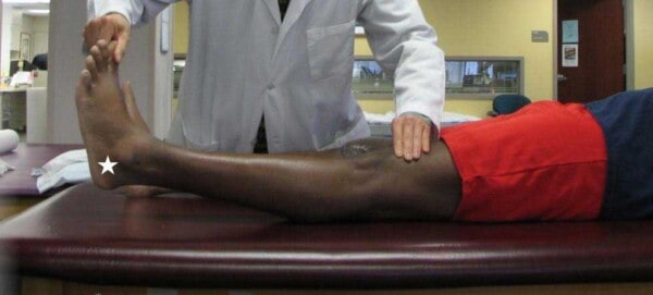 Genu Recurvatum | Knee Hyperextension | Knee Specialist | Minnesota