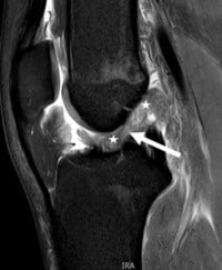 ACL Tear | Anterior Cruciate Ligament Injury | Knee Specialist | Minnesota