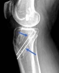 PCL Reconstruction | Posterior Cruciate Ligament Surgery | Minnesota