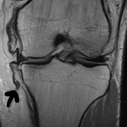 MCL Reconstruction | Medial Collateral Ligament Surgery | Minnesota