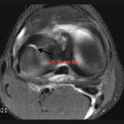 Lateral Meniscus Radial Tear with Separation