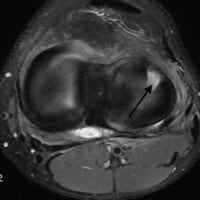 Lateral Meniscus Radial Tear with Separation