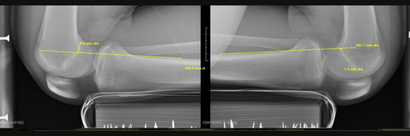 PCL Stress Radiograph Technique | Edina, Egan, MN